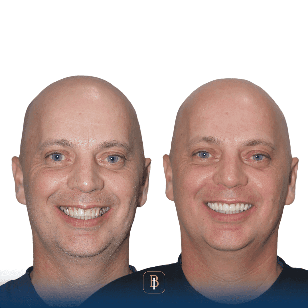 Dental Implants Brisbane | Brisbane Implants